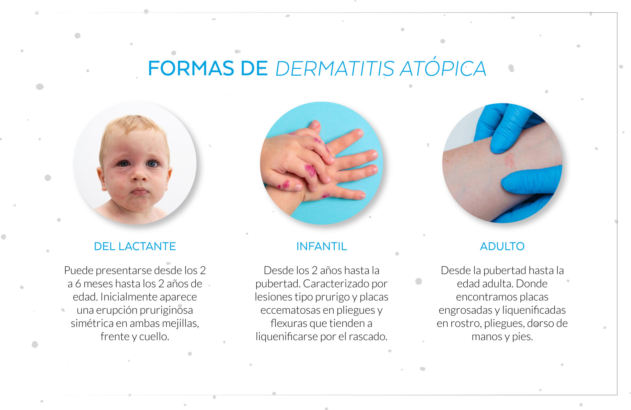 Dermatitis Atópica - Bassa