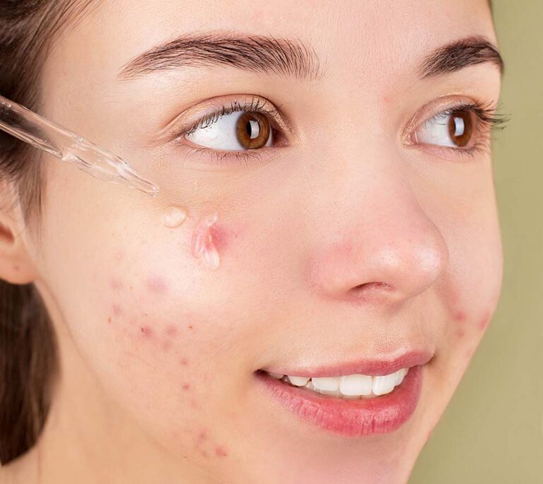 Tratamientos de acné para tu piel - Bassa